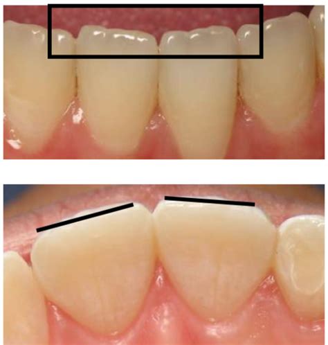 Permanent Anterior Teeth Incisors Flashcards Quizlet