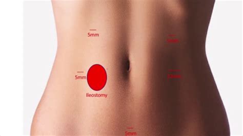 Laparoscopic Total Colectomy With End Ileostomy Youtube