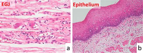 Esophagus Microscopic View A Slight Myenteric Plexus Inflammation