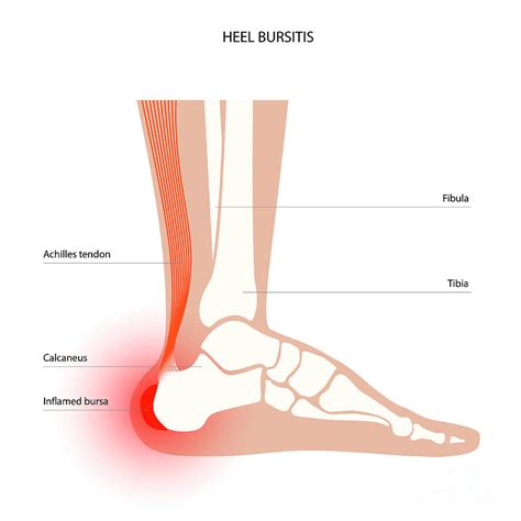 Heel Bursitis 3 Photograph By Pikovit Science Photo Library Pixels