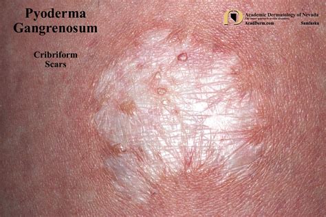 Pyoderma Gangrenosum Its Not An Infection Academic Dermatology