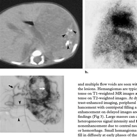 Suspected Hepatic Avm A Selective Hepatic Angiogram Demonstrates A