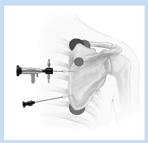 Portals Used For Bursectomy In Arthroscopic Treatment Of Download Scientific Diagram