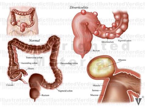 Diverticulitis Abscess