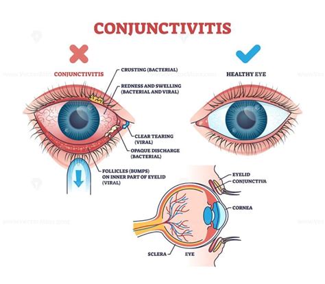 Conjunctivitis Or Pink Eye Medical Condition Explanation Outline