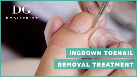 Ingrown Fingernail Treatment