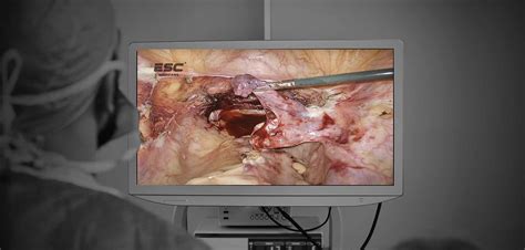 Fhd Lp 5100 Endoscopy Camera With Light Source Esc Medicams