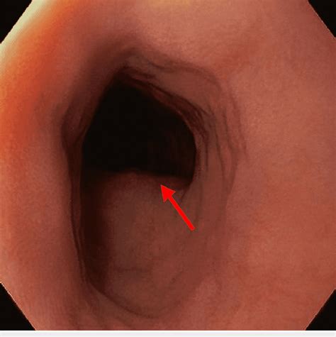 Egd Showing External Compression Red Arrow Posterior To The Esophagus Download Scientific