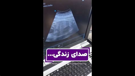 صدای ضربان قلب جنین