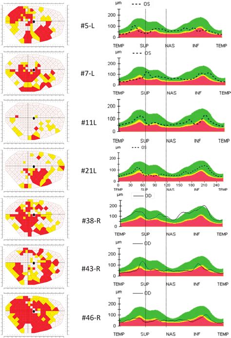 Cases Classified As Temporal Wedge Defects Defects At The Level Are