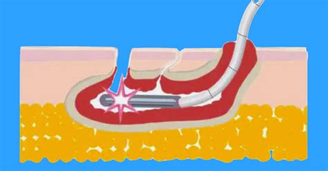ΘΕΡΑΠΕΙΕΣ Laser Λαρεντζάκης Χειρουργός Ογκολόγος Γενικός Χειρουργός