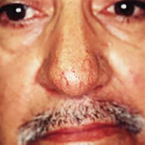 Patient 37504801 Vascular Lesion Laser Treatment Before And After