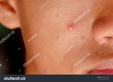 Papules On Face