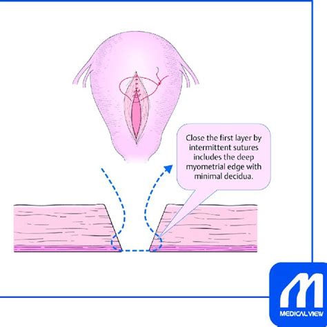 Pdf Classical Cesarean Section