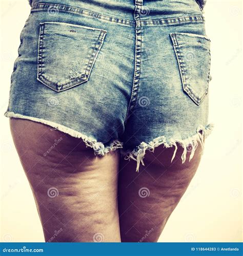 Bad Cellulite Thighs