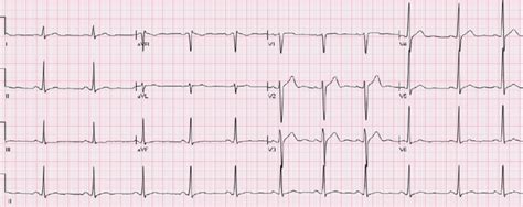Stemi Mimics Resus
