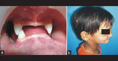 Functional Esthetic Rehabilitation Of A 7 Year Female Patient With Hereditary Ectodermal