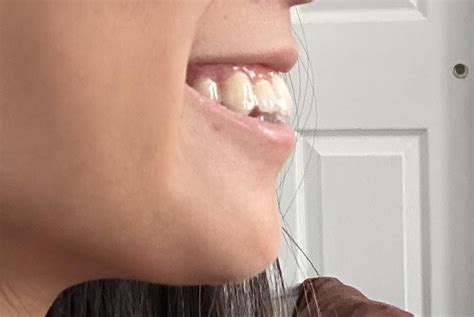 Can I Ask My Ortho To Do Ipr R Invisalign