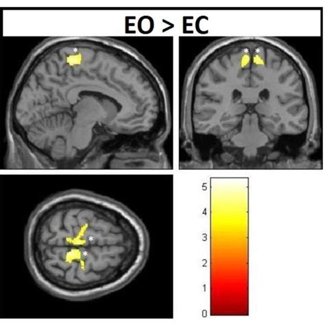 Voxel Based Morphometry Vbm Observed Gray Matter Gm Download Scientific Diagram