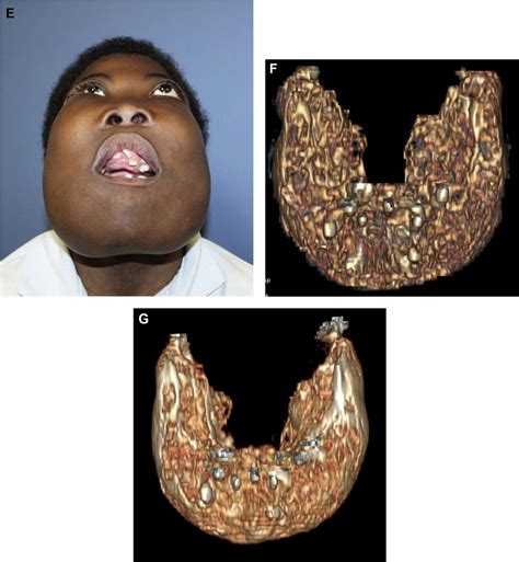 A Paradigm Shift In The Management Of Cherubism A Preliminary Report