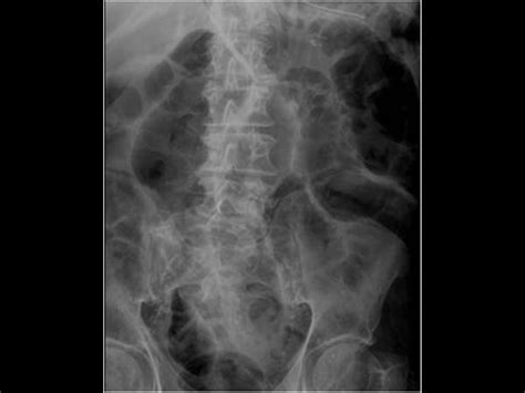 Abdomen And Retroperitoneum 1 6 Gastrointestinal Tract Case 1 6 7 Duodenum And Small Bowel