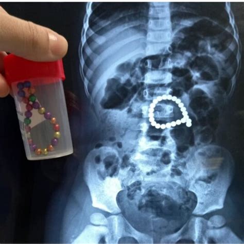 Abdominal Radiograph With Ring Like Radio Opaque Structure And The