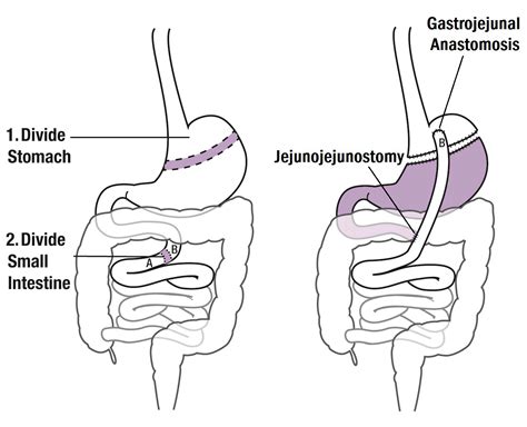 Jejunojejunostomy