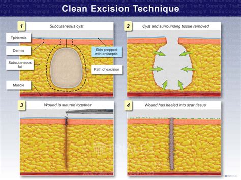 Clean Excision Technique