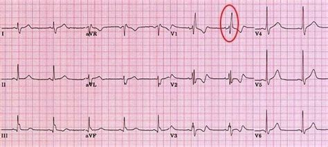 Right Bundle Branch Block Ekg Ekg Interpretation Nursing Mnemonics