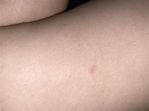 Bed Bug Bites R Bugbite
