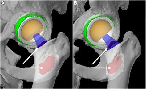 Safe Sex After Total Hip Arthroplasty Using Computed Tomography Based Robotics To Evaluate At