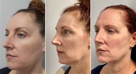 Ozempic Face Before And After Considerations