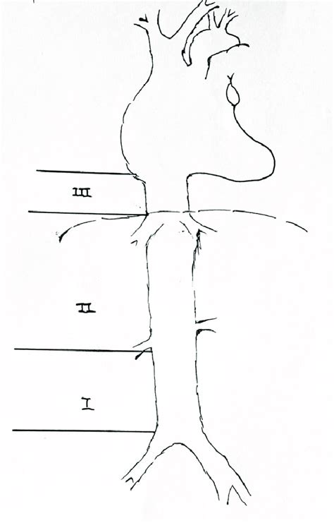 Anatomical Categorization Of Leiomyosarcoma Of Ivc Origin Download
