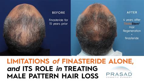 Why Finasteride Is Limited In Thickening Thinning Hair And Getting