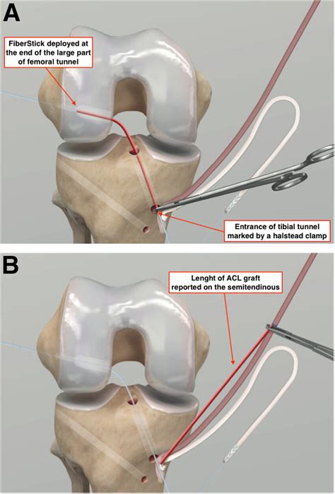 Measurement Of The Anterior Cruciate Ligament Acl Graft Using The Measurement Of The Anterior Cruciate Ligament Acl Graft Using The