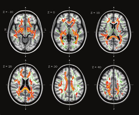 Tract Based Spatial Statistics Group Comparison Of White Matter Download Scientific Diagram