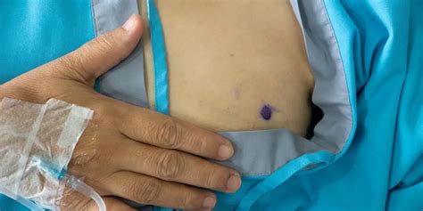 Lumpectomy What Is It Procedure And Recovery