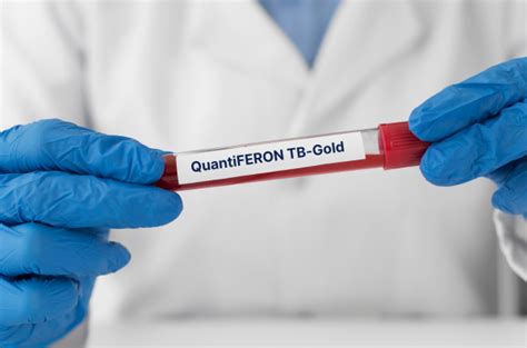 Quantiferon Gold Standard Test Genics Laboratories Las Vegas Nv