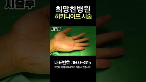 Shorts ] 손가락이 안 펴질 때는 털보의사에게 시술 방아쇠수지 비수술치료 Youtube