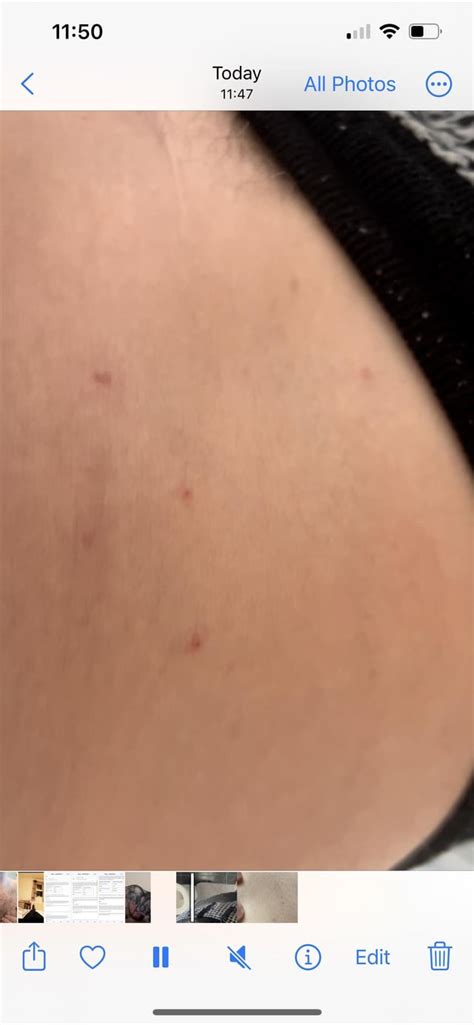 Updated Post With Pictures Rash On Groin 7 Weeks After Possible