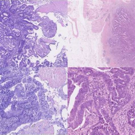 Most Common Mutations In Sinonasal Intestinal Type Adenocarcinoma