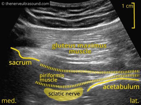 Standard Sections Sciatic Nerve The Nerve Ultrasound