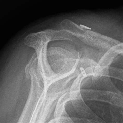 Acj Dislocation The Bone School