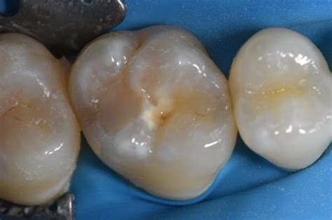 Molar Hypomineralization Exhibiting Caries