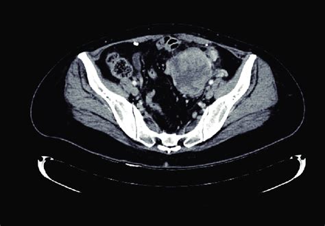 Computed Tomography Scan Showing The Left Adnexal Mass Download Scientific Diagram