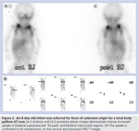 Diagnosis And Corresponding Gallium Scan