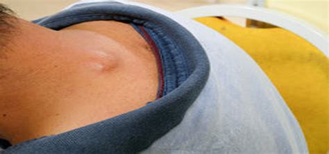 Understanding Sebaceous Cysts Symptoms Causes And Treatment