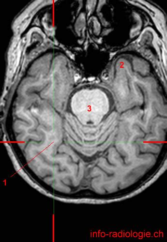 The Occipital Lobe W Radiology