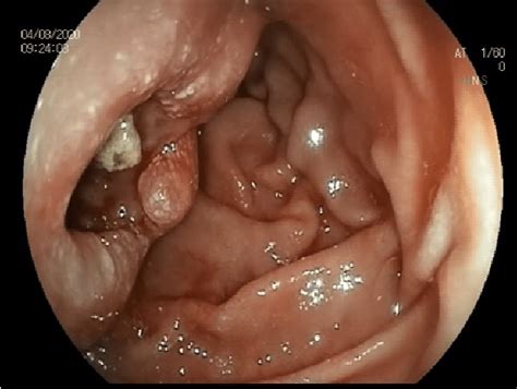 Control Endoscopy Of Deep Ulcer In The Proximal Part Of The 3rd Segment Download Scientific