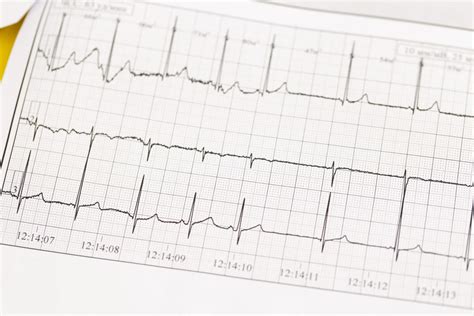 Prolongamento Do Intervalo QT NYSORA